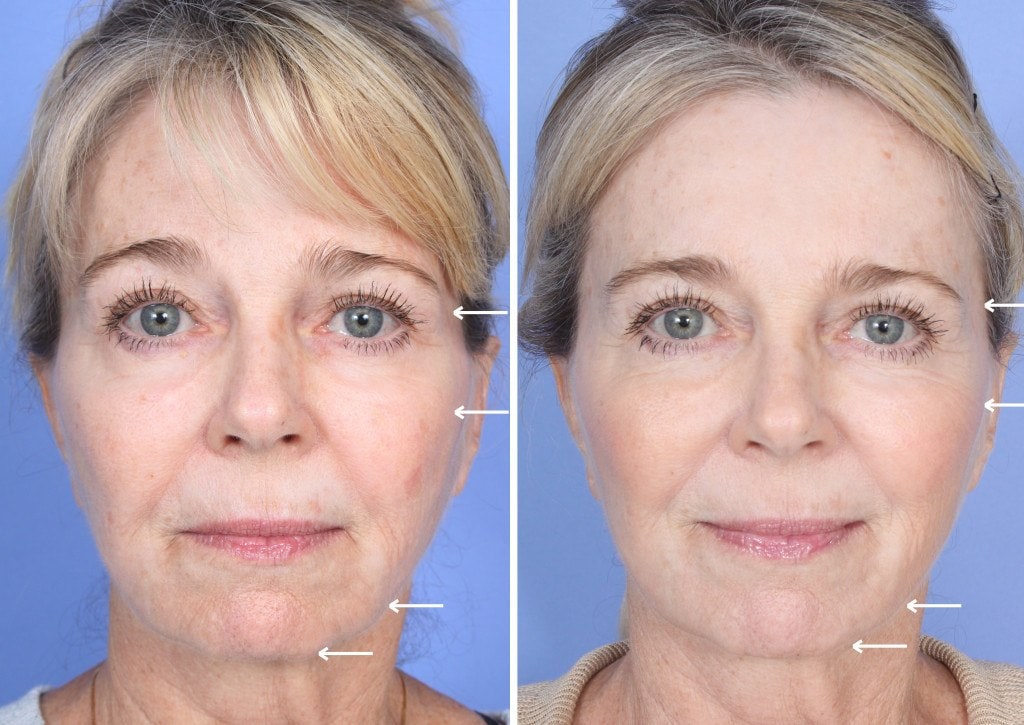 Sculptra Before and After Photos - Natural Image OC