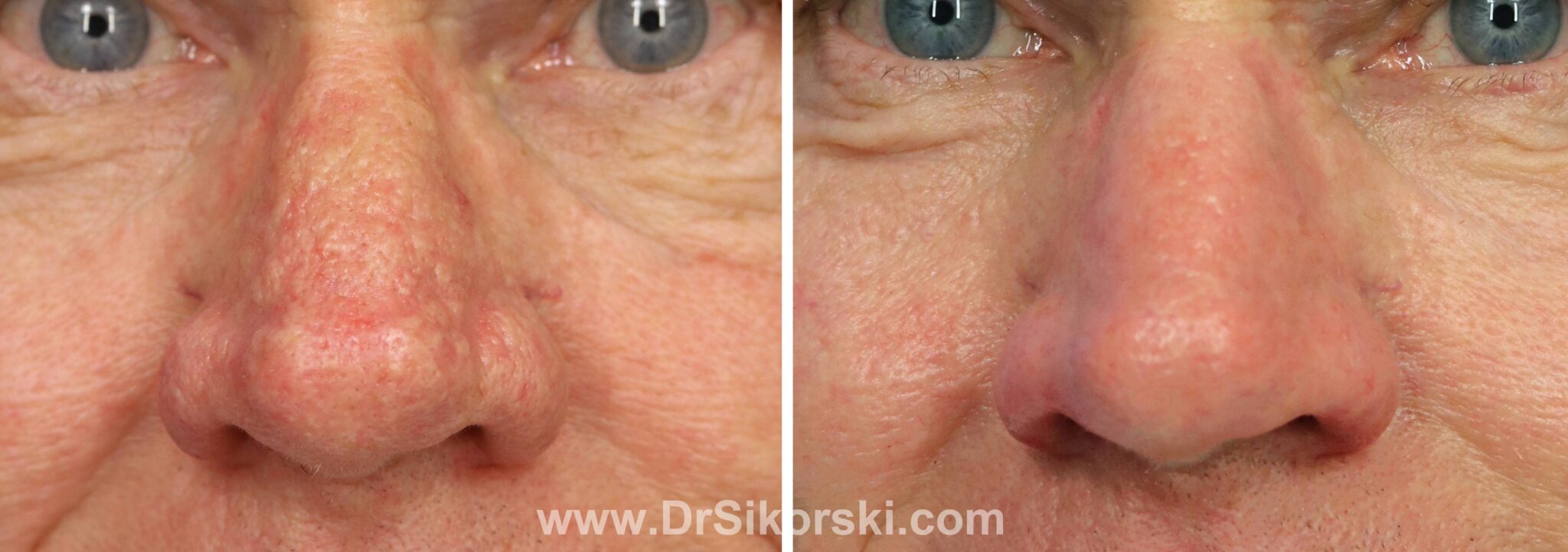 Rhinophyma Before and After Photos - Natural Image OC