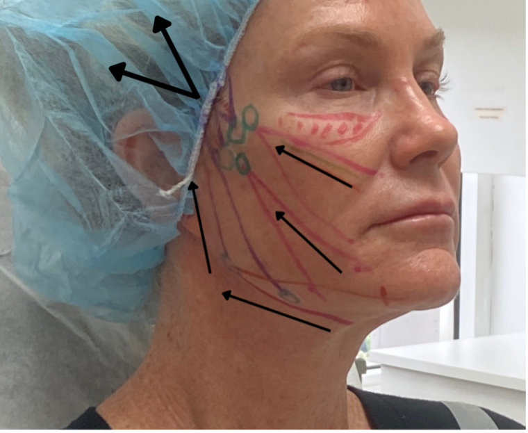 Facial Thread Lifts (“V-Lifts”) in Laguna Niguel
